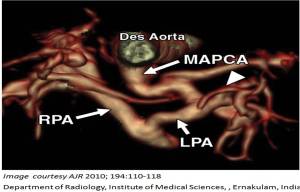 pda vs mapcas | Dr.S.Venkatesan MD
