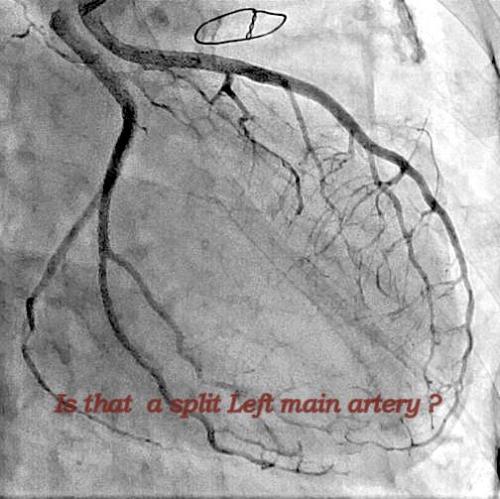 left anterior descending artery | Dr.S.Venkatesan MD