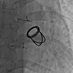 starr edwards valve | Dr.S.Venkatesan MD