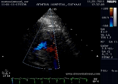 ventricular septal rupture | Dr.S.Venkatesan MD