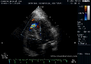 ventricular septal rupture | Dr.S.Venkatesan MD