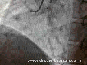 Bridging collaterals | Dr.S.Venkatesan MD