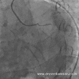 Eccentric plaques : Another grey area in interventional cardiology ...