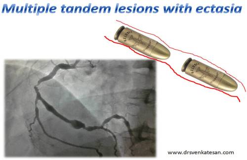 tandem coronary lesions | Dr.S.Venkatesan MD