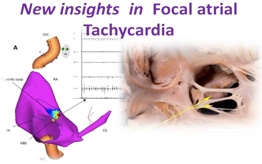 What are the “Nine” vulnerable points in the atria for focal atrial ...