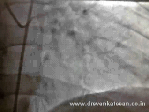 intra stenotic coroanry artery dilatation | Dr.S.Venkatesan MD