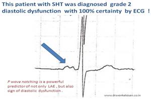 diastolic dysfunction | Dr.S.Venkatesan MD