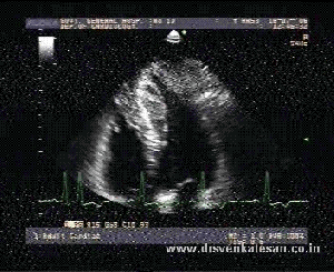 apical hypertrophy | Dr.S.Venkatesan MD