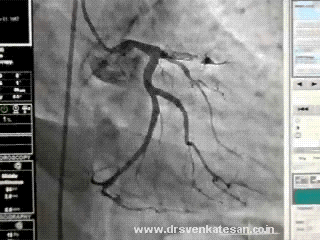 How does thrombus look like in coronary angiogram ? | Dr.S.Venkatesan MD