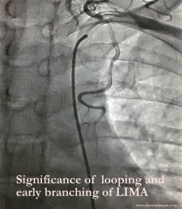 left internal thoracic artery | Dr.S.Venkatesan MD
