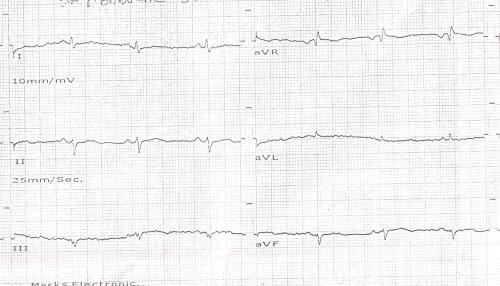 ECG diagnosis of thickened epicardial fat pad . | Dr.S.Venkatesan MD