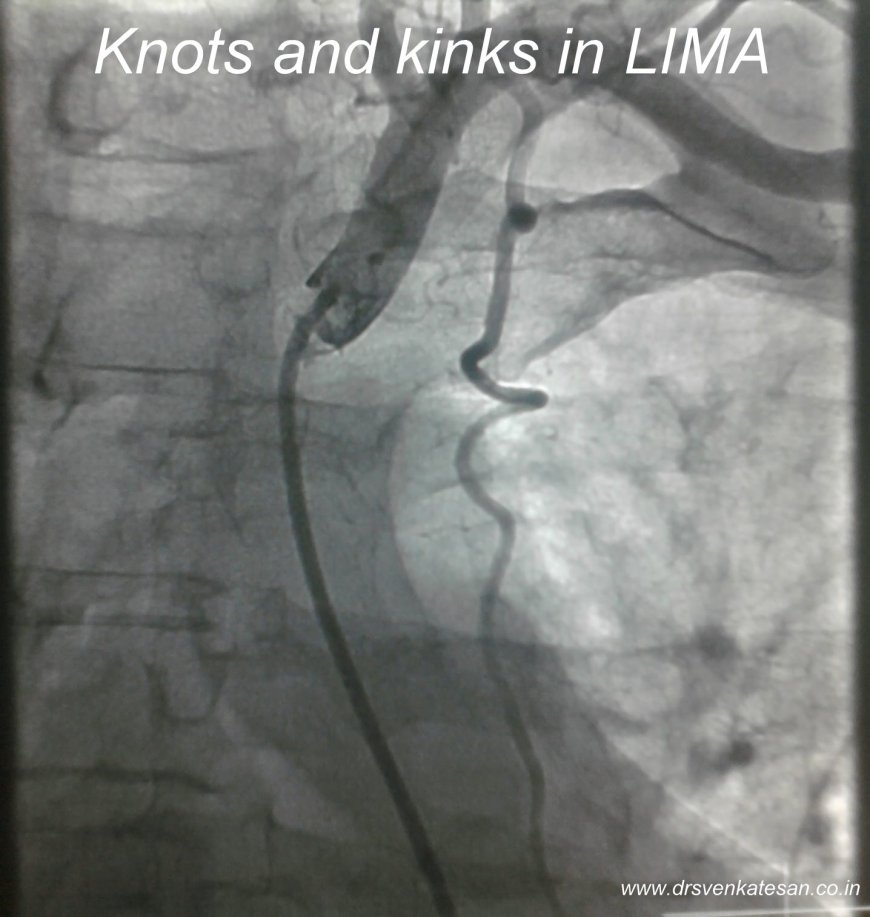 radial vs lima | Dr.S.Venkatesan MD