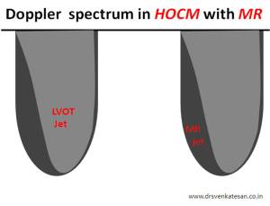 mitral valve in hcm hocm | Dr.S.Venkatesan MD