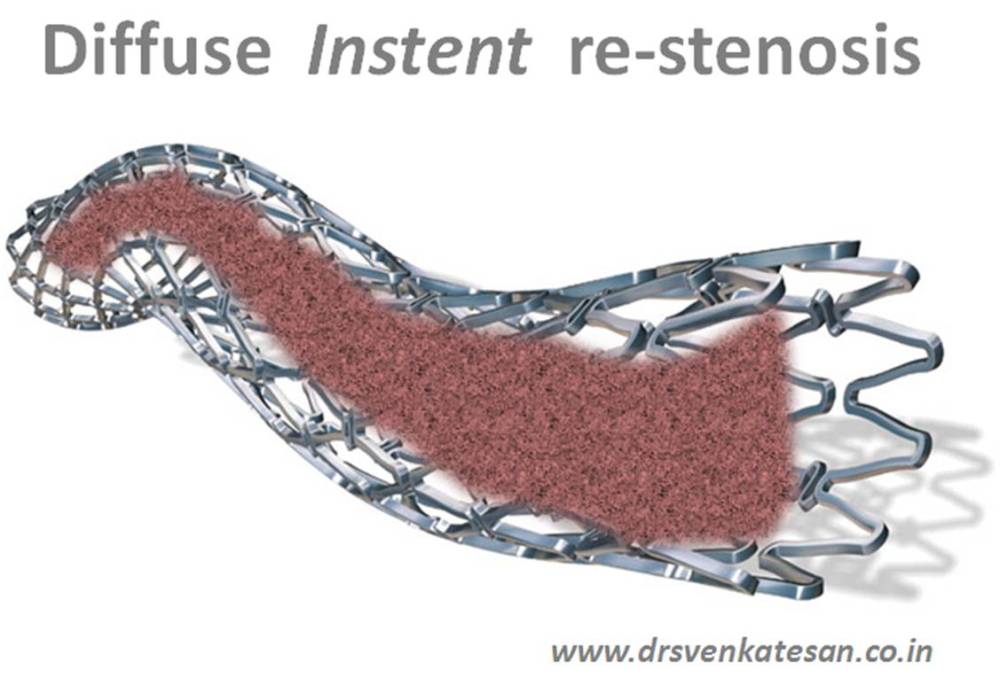 What is the best intervention for critical in-stent restenosis (ISR ...