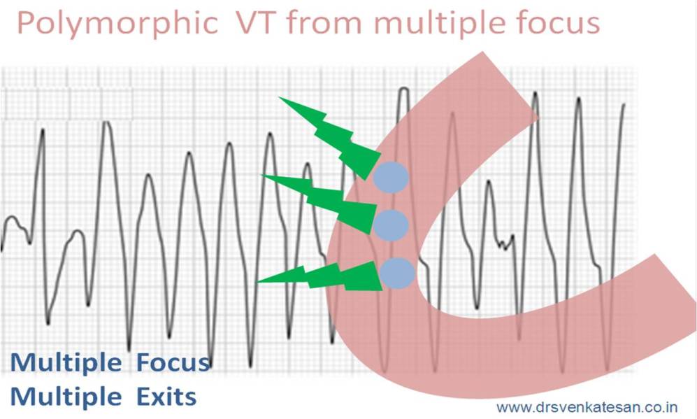 Different “Avatars” of ventricular tachycardia : Multifocal vs ...