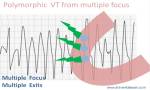 Different “Avatars” of ventricular tachycardia : Multifocal vs ...