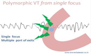 Different “Avatars” of ventricular tachycardia : Multifocal vs ...