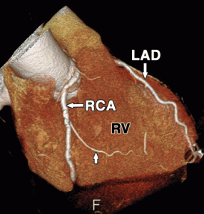 anterior and posterior interventricular groove | Dr.S.Venkatesan MD