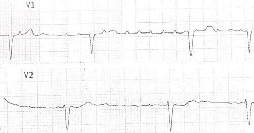 complete heart block in af | Dr.S.Venkatesan MD