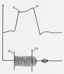 Giant “v” waves of tricuspid regurgitation | Dr.S.Venkatesan MD