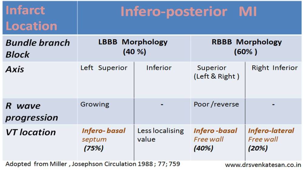 ventricular tachycardia | Dr.S.Venkatesan MD