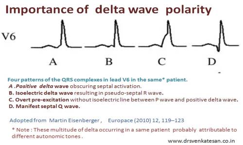 Delta wave blues in WPW syndrome : What is the relationship between ...