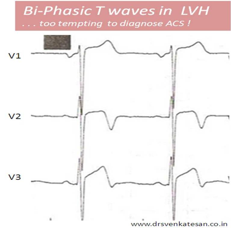 ecg mimickers of stemi | Dr.S.Venkatesan MD
