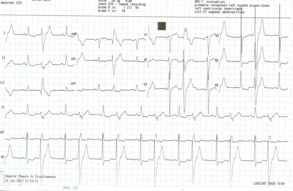 mitral inflow during vpds | Dr.S.Venkatesan MD