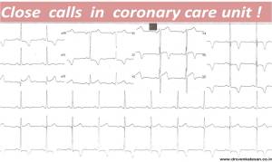 ecg mimickers of stemi | Dr.S.Venkatesan MD