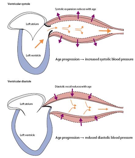 Isolated Systolic Hypertension Isolated Systolic Hypertension In The