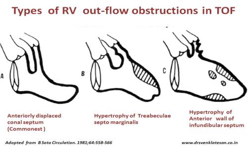 rv muscle bundle in tof | Dr.S.Venkatesan MD