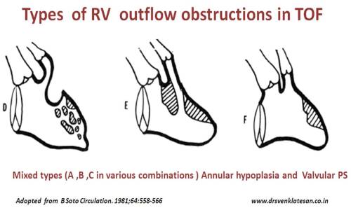rv muscle bundle in tof | Dr.S.Venkatesan MD