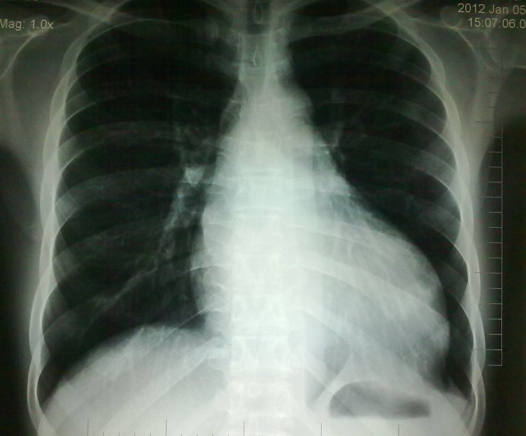 ecg in lv volume overload | Dr.S.Venkatesan MD