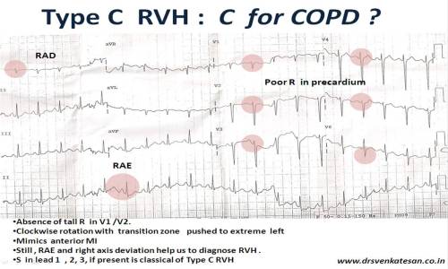 Importance of recognising type C RVH in clinical cardiology ! | Dr.S ...