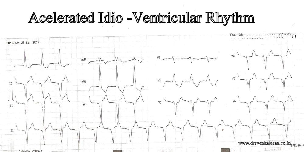 accelerated idioventricular rhythm | Dr.S.Venkatesan MD