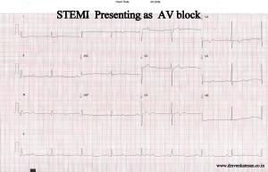Unusual presentation of STEMI : Mobitz type 2 AV block | Dr.S.Venkatesan MD