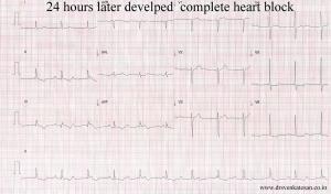 Unusual presentation of STEMI : Mobitz type 2 AV block | Dr.S.Venkatesan MD
