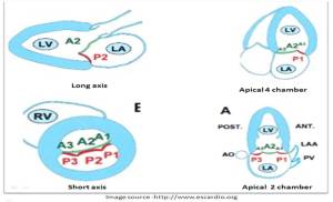 mitral valve scallop | Dr.S.Venkatesan MD
