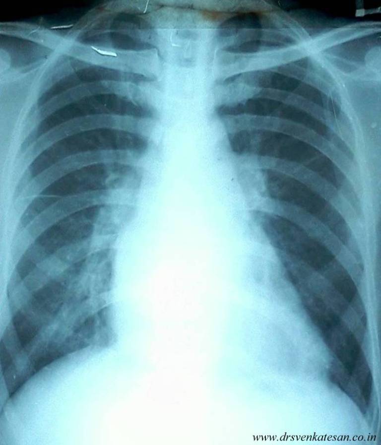 Why left heart border become straight in Mitral stenosis ? | Dr.S ...