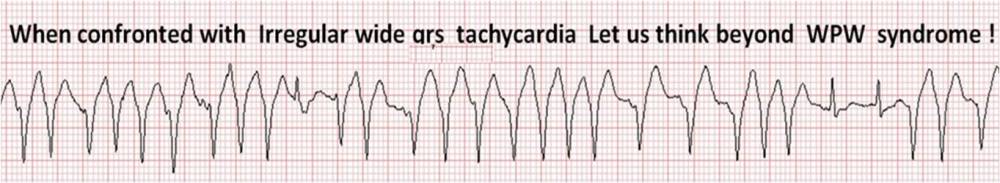Atrial fibrillation with wide qrs tachycardia : Don’t get obsessed with ...