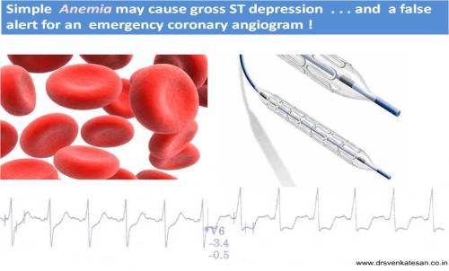 anemia and ST depression | Dr.S.Venkatesan MD