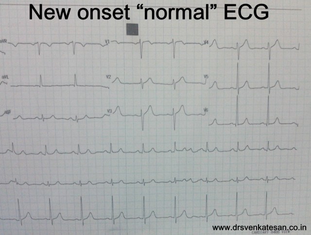 Ecg Frontiers | Long Term Single Lead Electrocardiogram Monitoring To