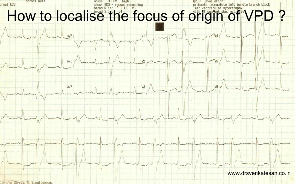 How to localise the focus of origin of VPD ? | Dr.S.Venkatesan MD