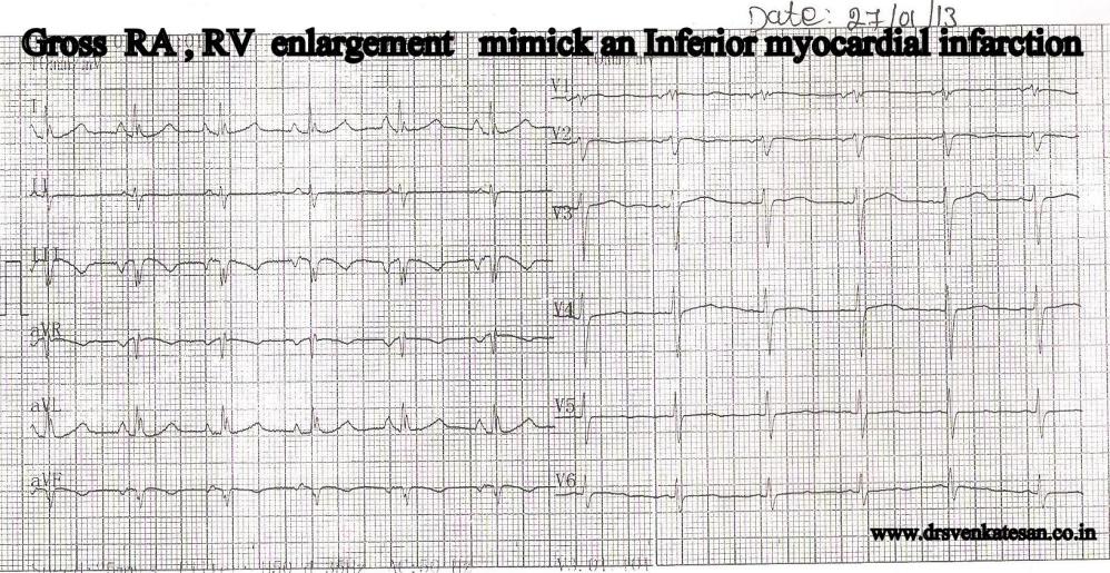 inferior mi differential diagnosis | Dr.S.Venkatesan MD