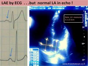 left atrial enlargement in ecg | Dr.S.Venkatesan MD