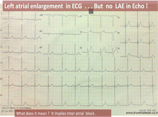 Ecg Suggests Lae Echo Reveals An Absolutely Normal JaypeeDigital