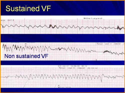 “Non sustained” ventricular fibrillation : A concept paper and a case ...