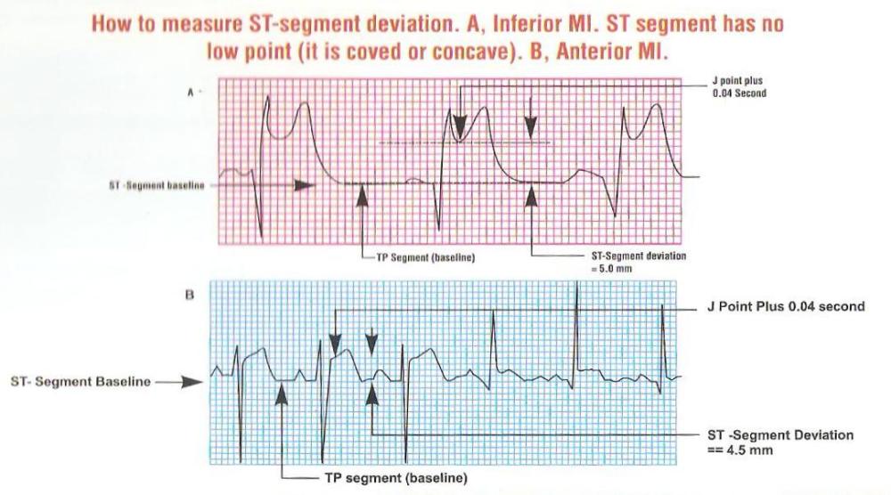 What is the reference point to measure ST elevation in STEMI ? | Dr.S ...