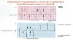 What is the reference point to measure ST elevation in STEMI ? | Dr.S ...