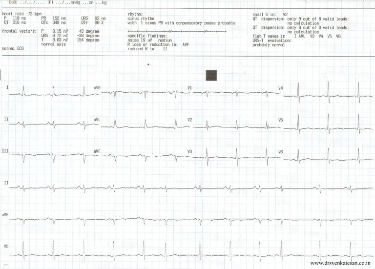 sinus node anatomy | Dr.S.Venkatesan MD